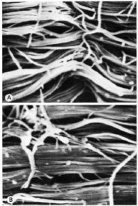 Βαθιά Εγκάρσια Ανάτριψη κατά Cyriax (Deep Friction Massage) – Kinetiks